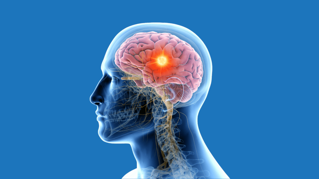 Often-Missed Signs of a CSF Leak | NJ Brain & Spine Experts